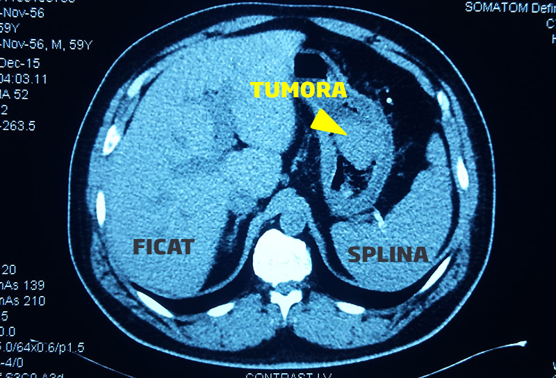 cancer gastric | Dr. Teodor Buliga